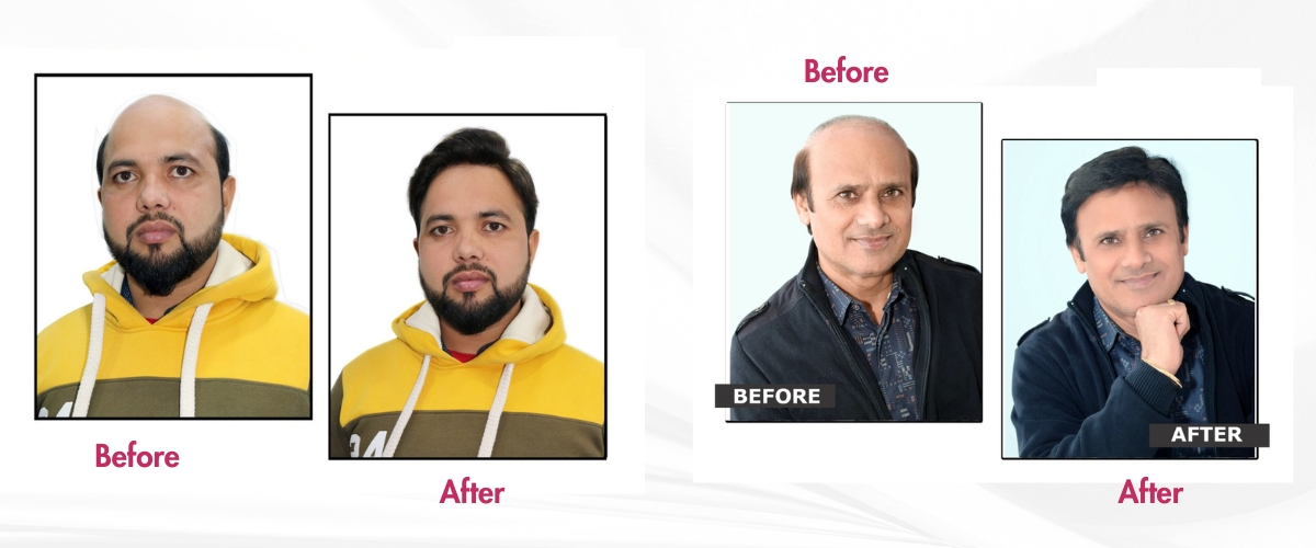 Baldness Solution Without Surgery – Ayub Hair Studio’s Non-Invasive ...